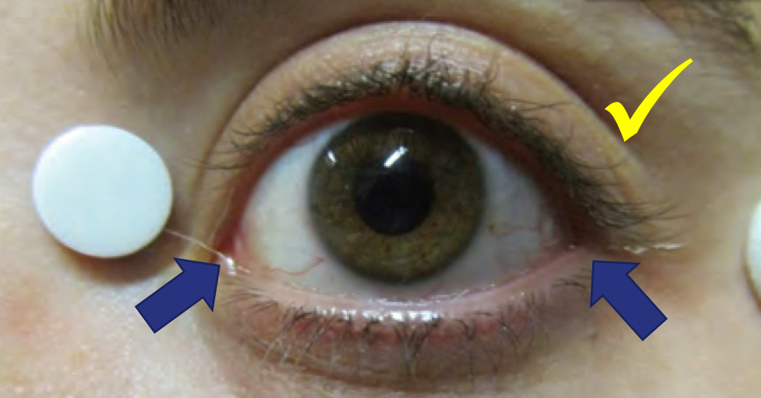 Checking Impedance | Electrode Connection Quality – Support